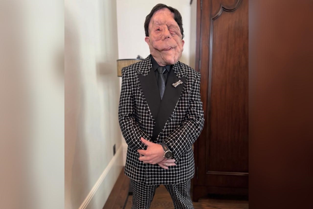 Neurofibromatose: conheça a condição rara enfrentada pelo ator Adam ...